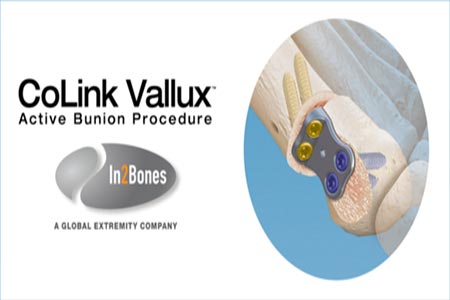 In2Bones Launches CoLink Vallux™ Active Bunion Procedure