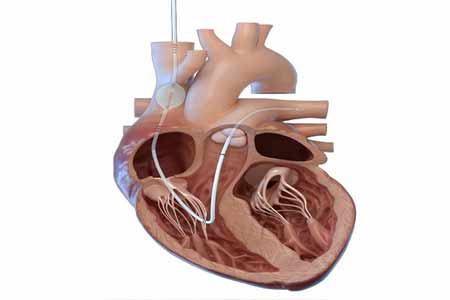 Early Feasibility Study Demonstrates Successful Use of Abiomed’s ...